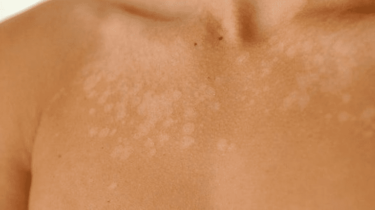 Micose de pele: 7 possíveis causas | Melhor Saúde